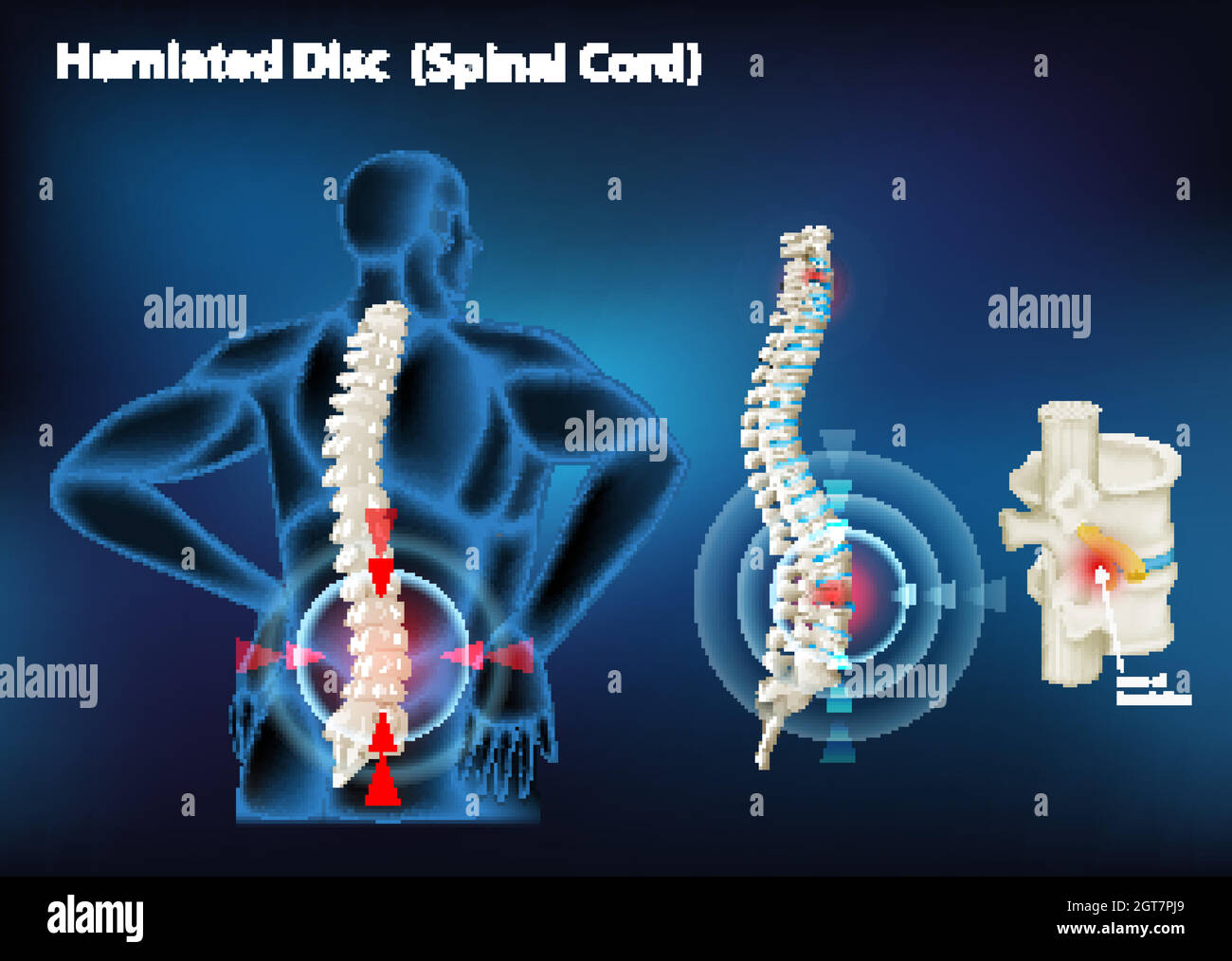 Diagram showing herniated disc in human Stock Vector Image & Art - Alamy