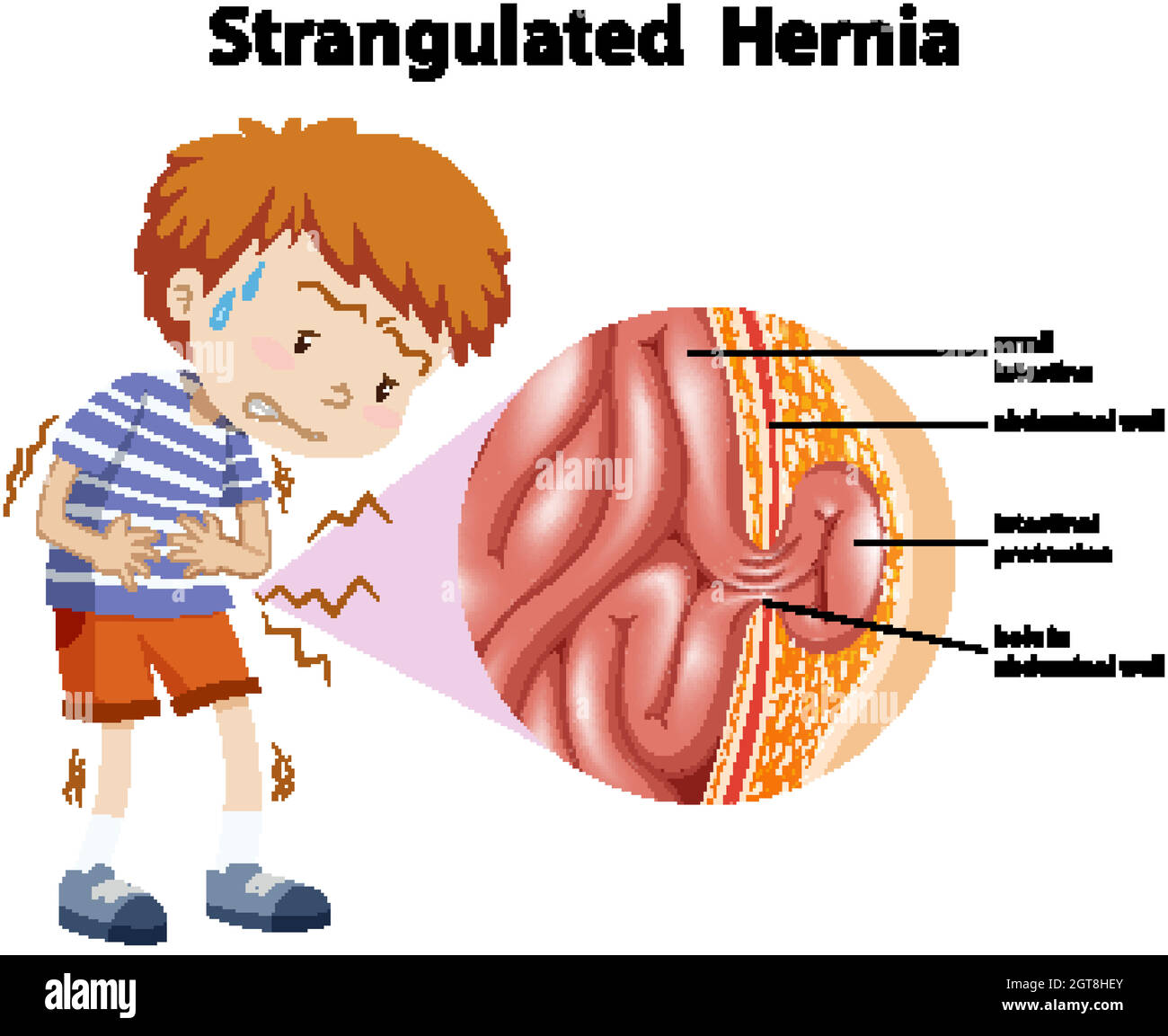 Boy with strangulated hernia on diagram Stock Vector Image & Art - Alamy