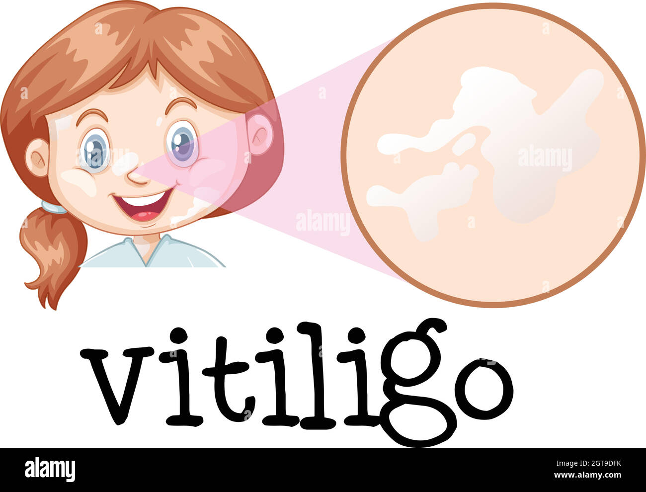 A Girl Face with Vitiligo Stock Vector Image & Art - Alamy