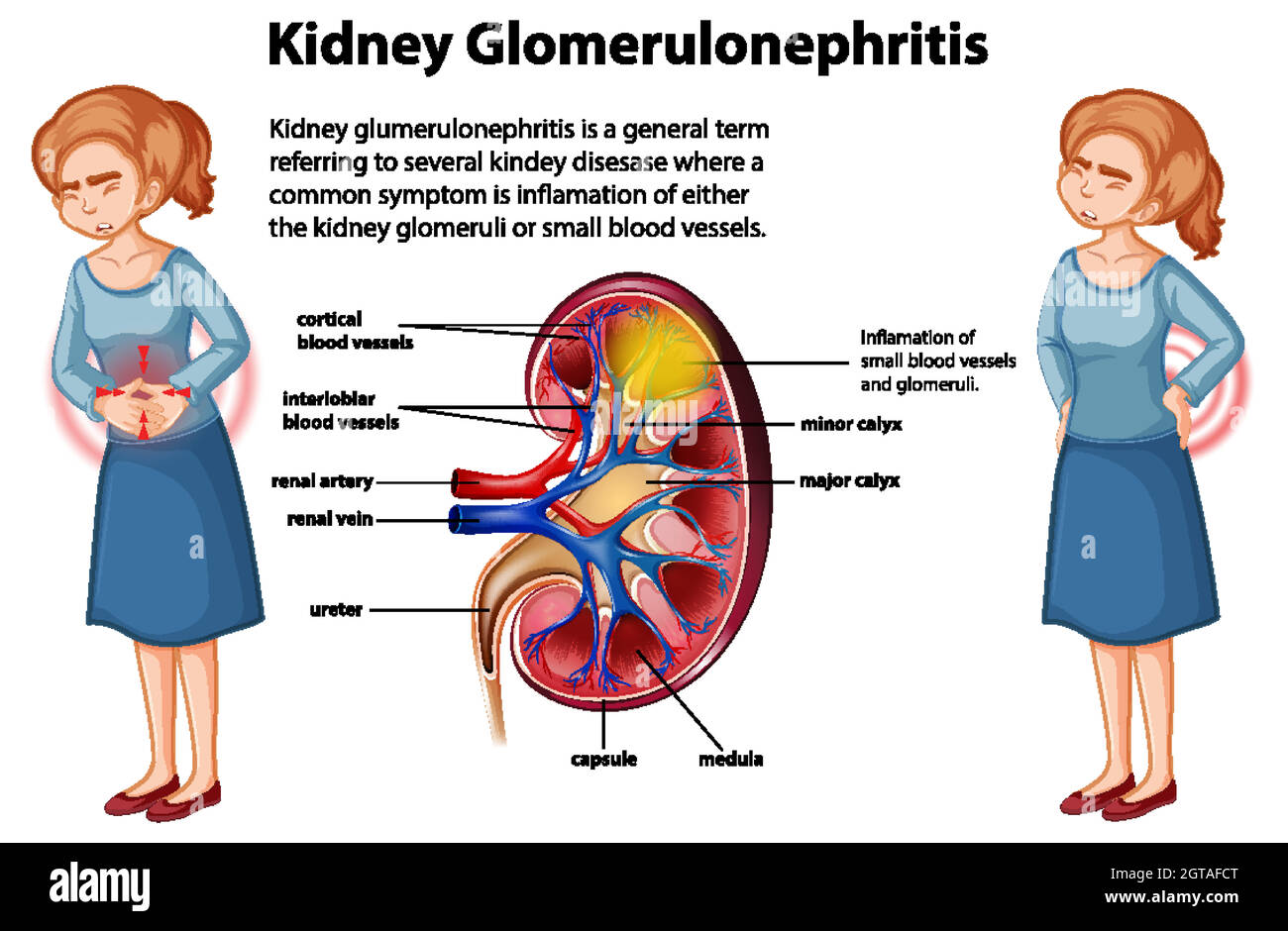 Glomerulosclerosis