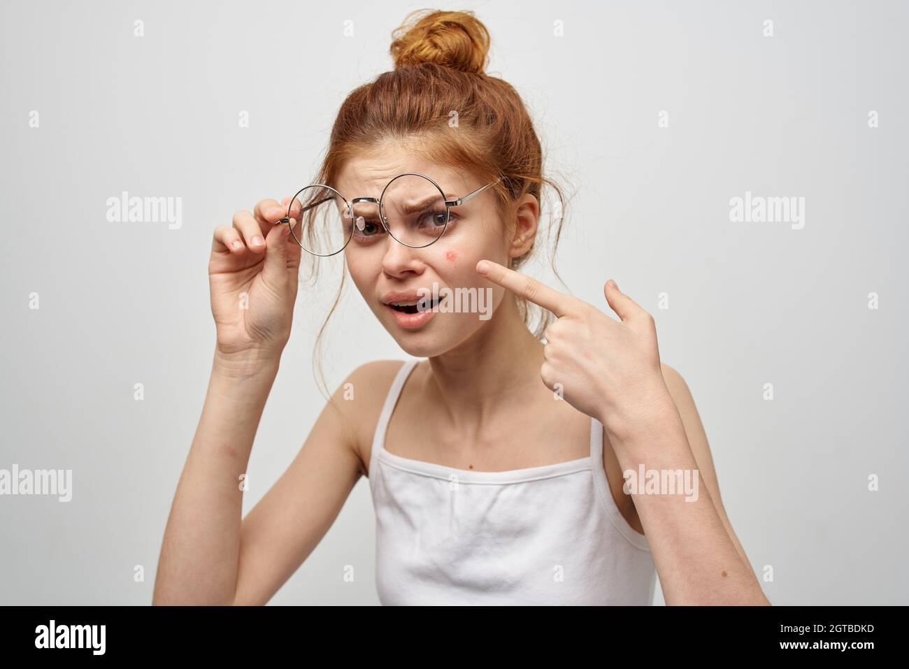 woman face with pimple skin problems close-up Stock Photo - Alamy