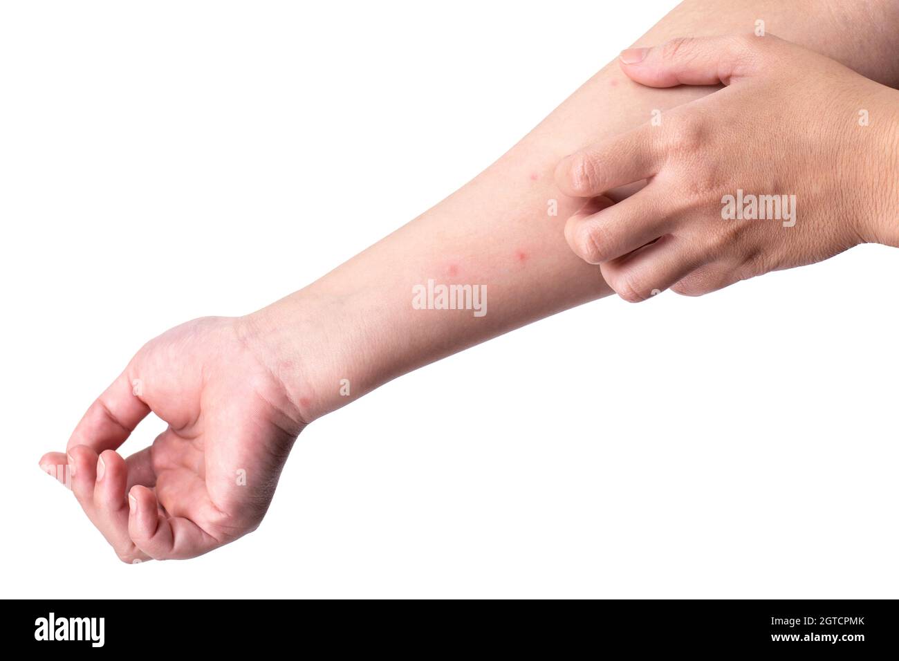 Shingles Rash Arm High Resolution Stock Photography and Images - Alamy