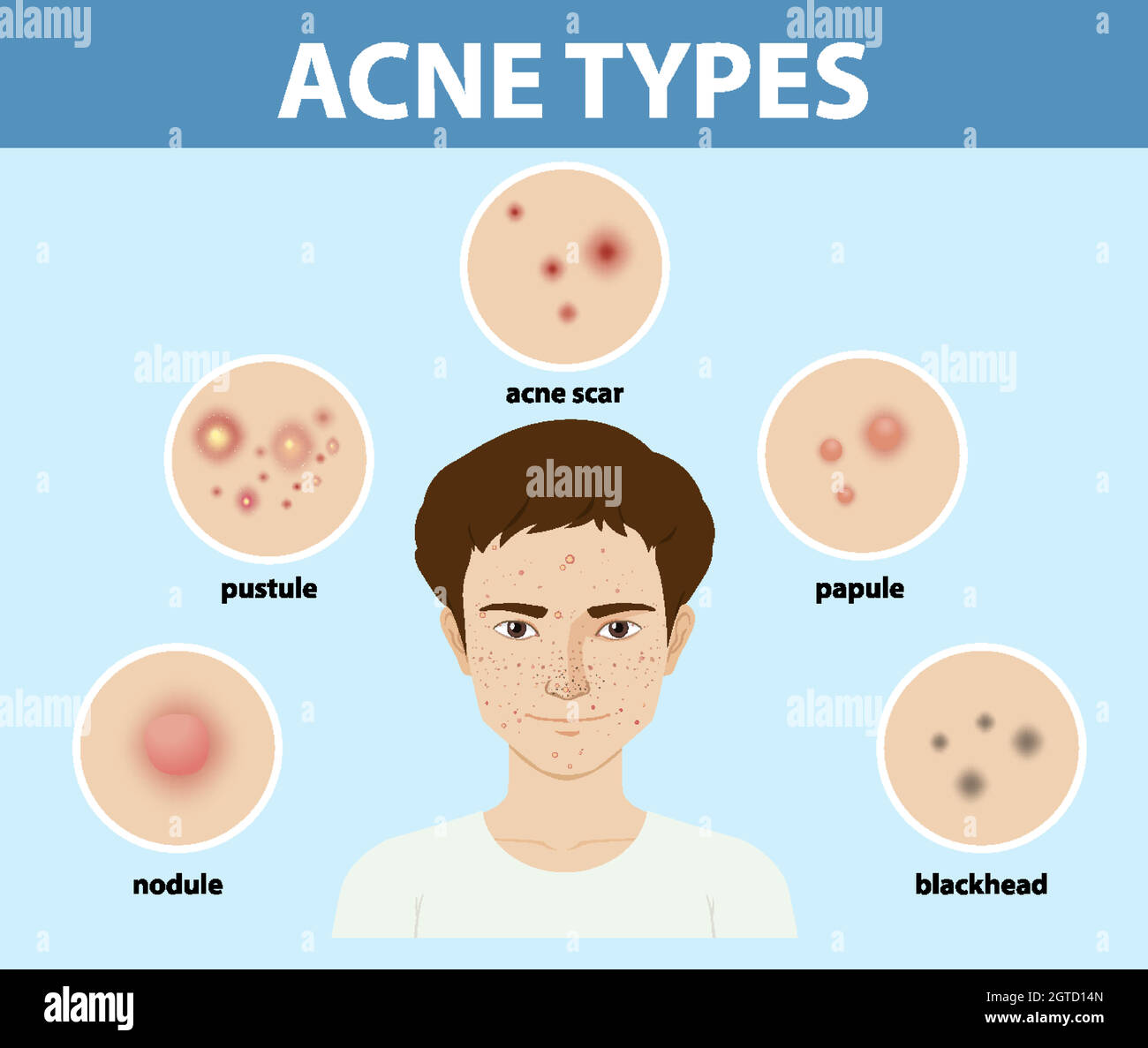 Types of acne on the skin or pimples Stock Vector Image & Art - Alamy
