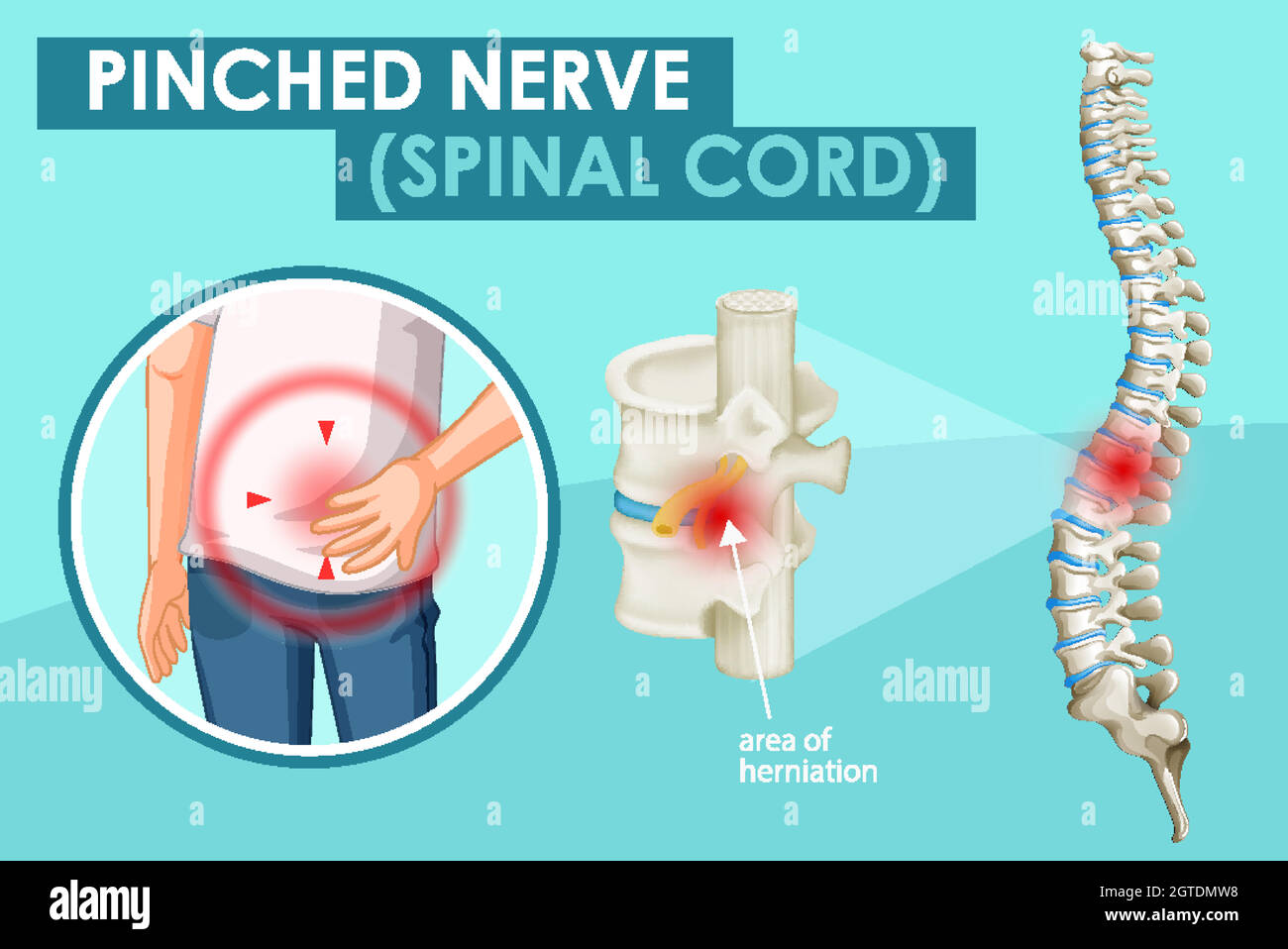 Diagram showing pinched nerve in human Stock Vector Image & Art - Alamy