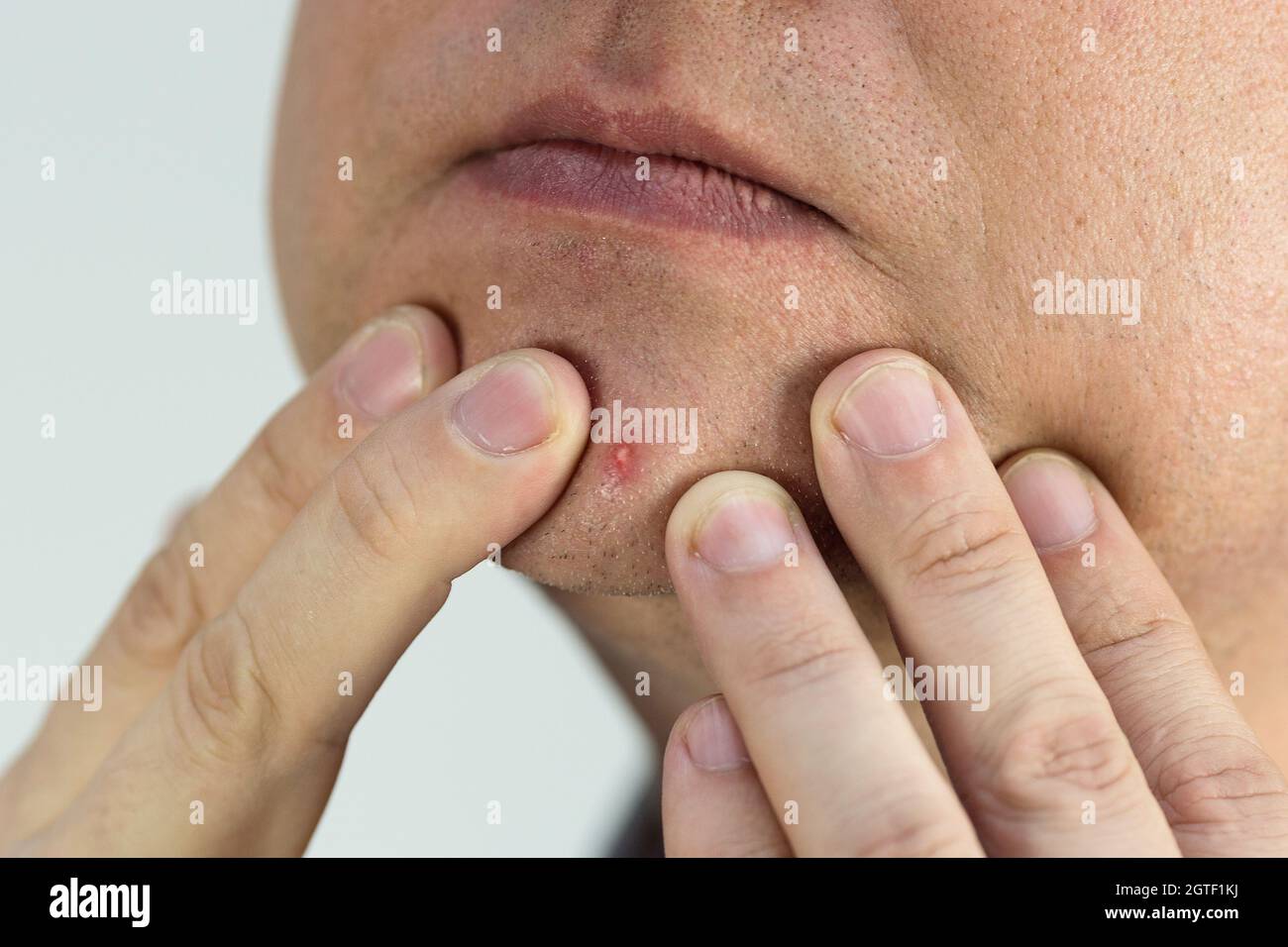 A large ripe pimple on a man's face, close-up Stock Photo - Alamy