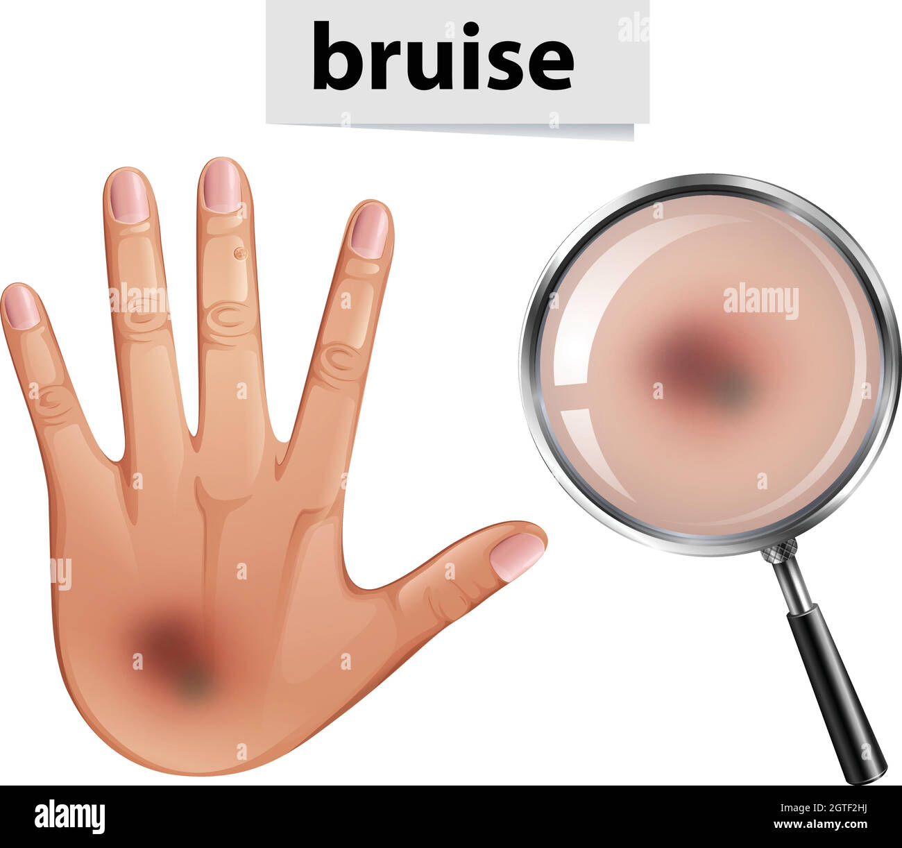 Bruised skin Stock Vector Images - Alamy