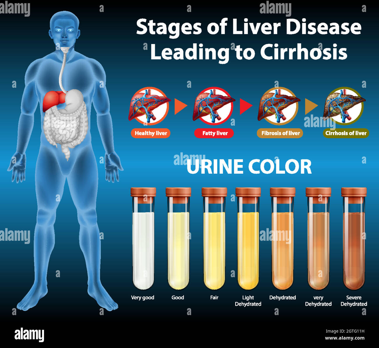 Stages of liver disease Stock Vector Image & Art - Alamy