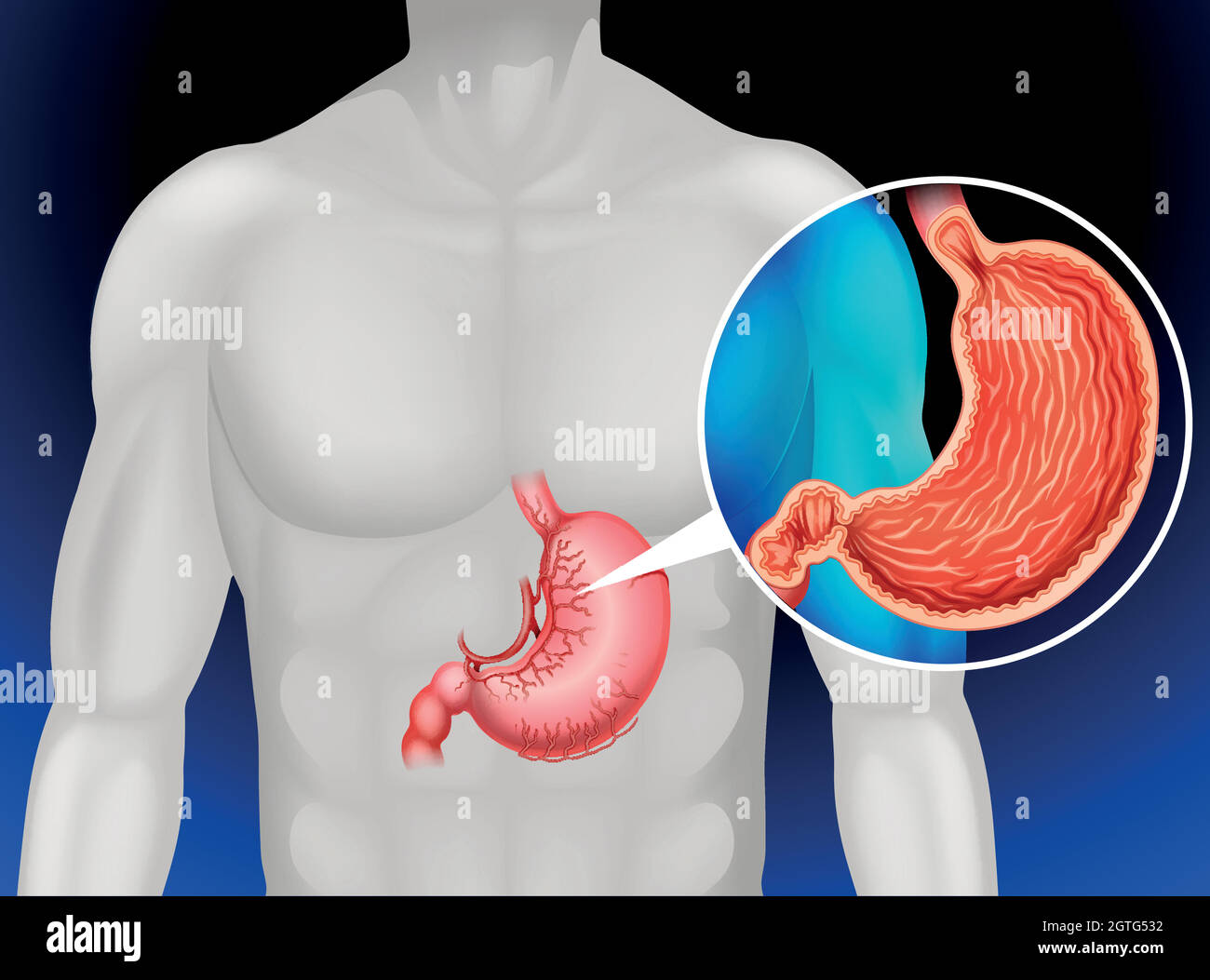 Stomach cancer in human Stock Vector Image & Art - Alamy