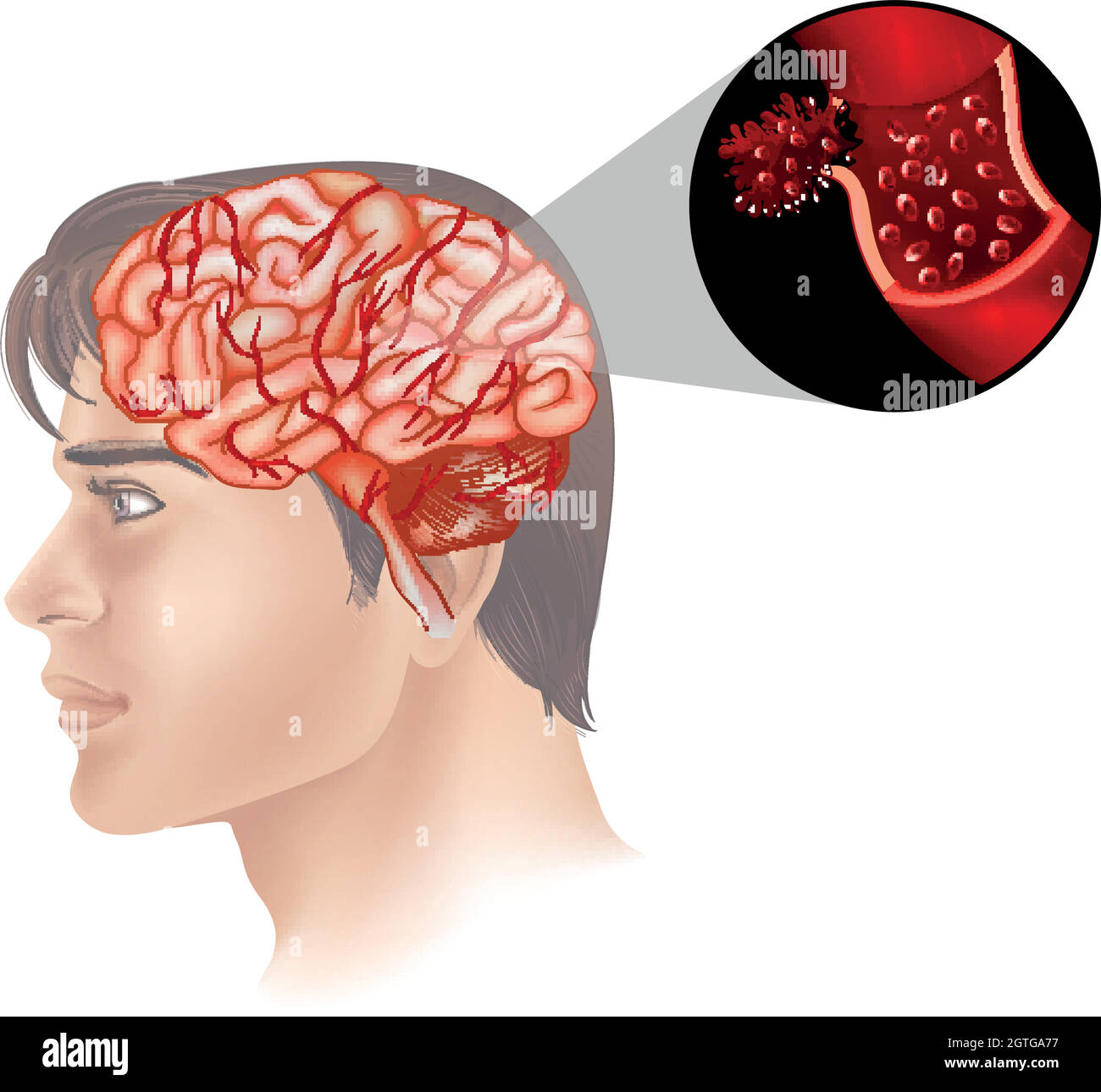 Brain cancer in human Stock Vector Image & Art - Alamy