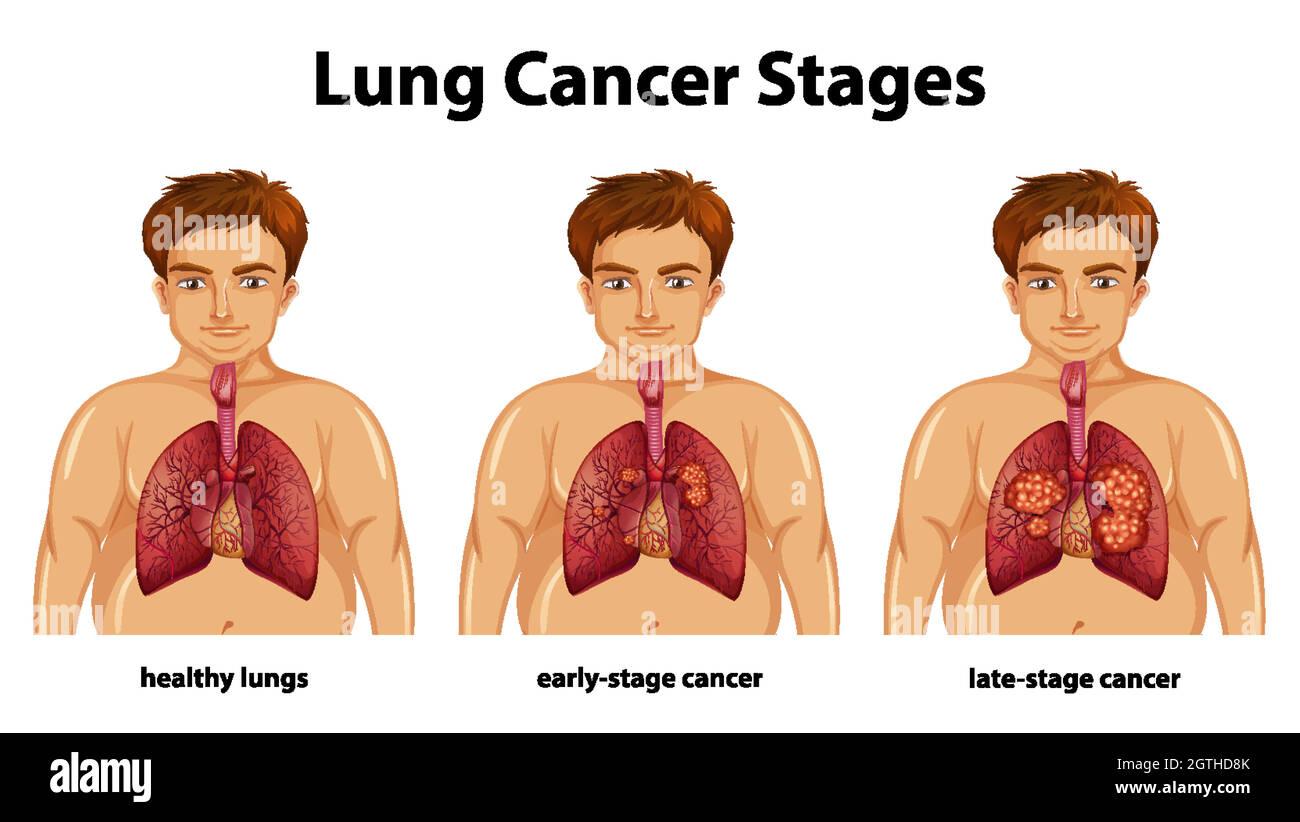 Informative illustration of lung cancer stages Stock Vector Image & Art ...