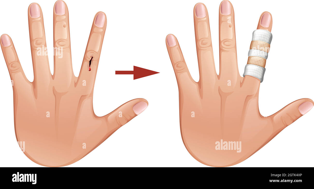 Cut on hand with bandage Stock Vector Image & Art - Alamy