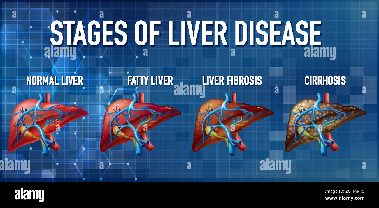 Liver cirrhosis drawing hi-res stock photography and images - Alamy