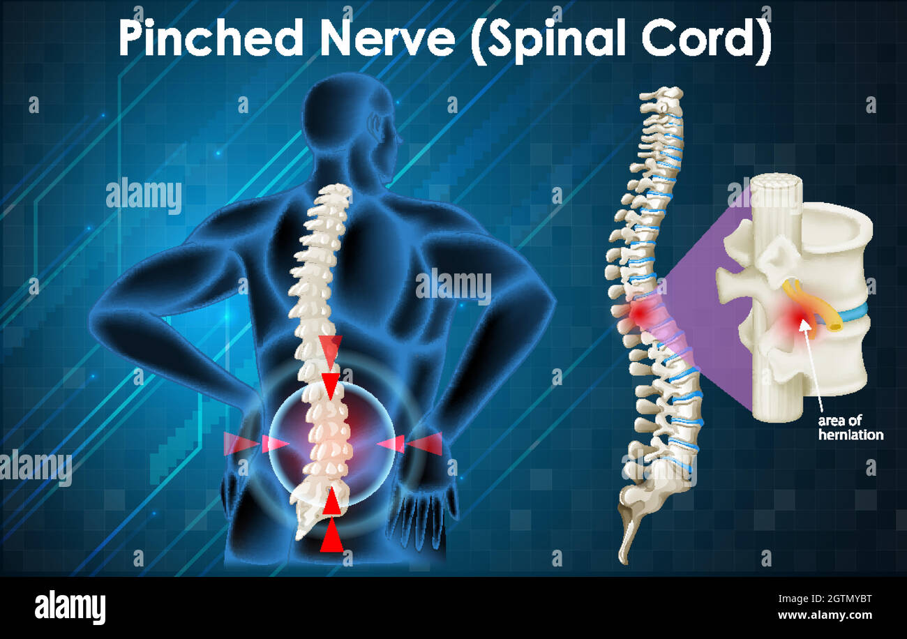 Diagram Showing Pinched Nerve In Human Stock Vector Image And Art Alamy