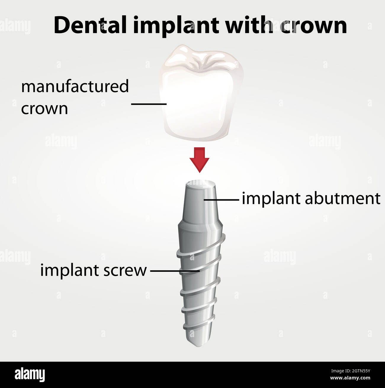 Root form endosseous implants hi-res stock photography and images - Alamy