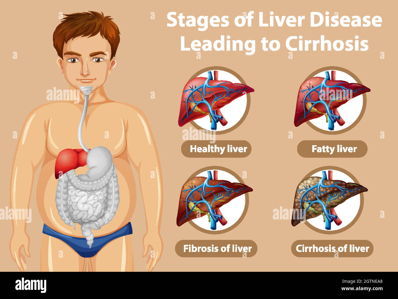 Stages of liver disease leading to Cirrhosis Stock Vector Image & Art ...