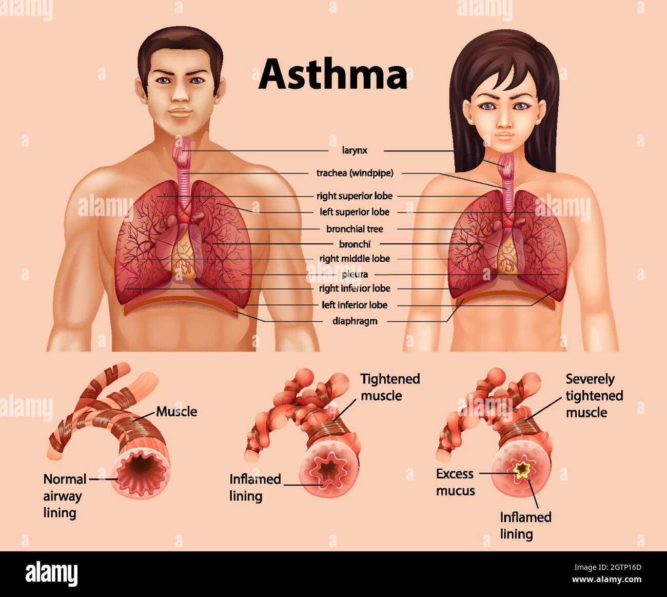 Comparison of healthy lung and Asthmatic lung Stock Vector Image & Art ...