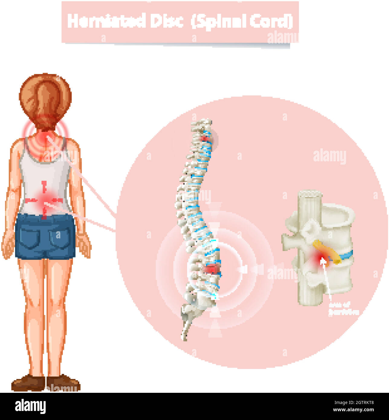 Diagram showing herniated disc Stock Vector Image & Art - Alamy