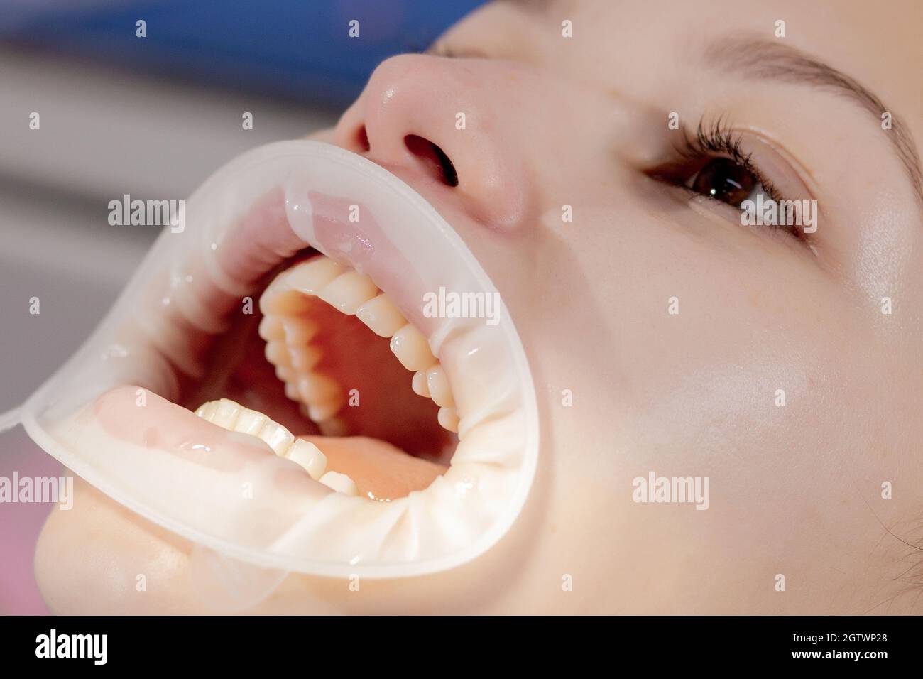 Dental cap. Professional cleaning of the space between the teeth. Young ...