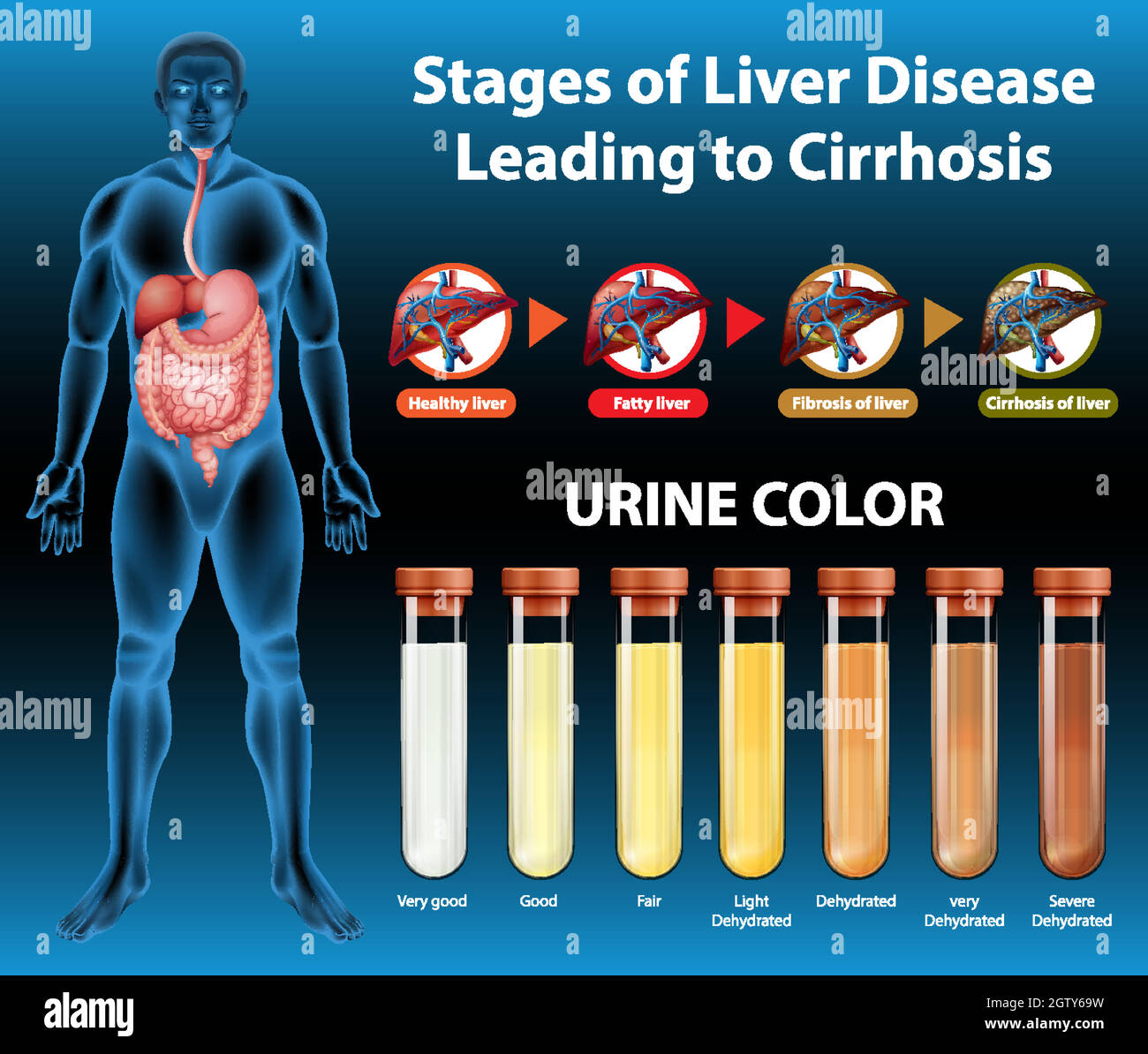 Stages of liver disease leading to Cirrhosis Stock Vector Image & Art ...