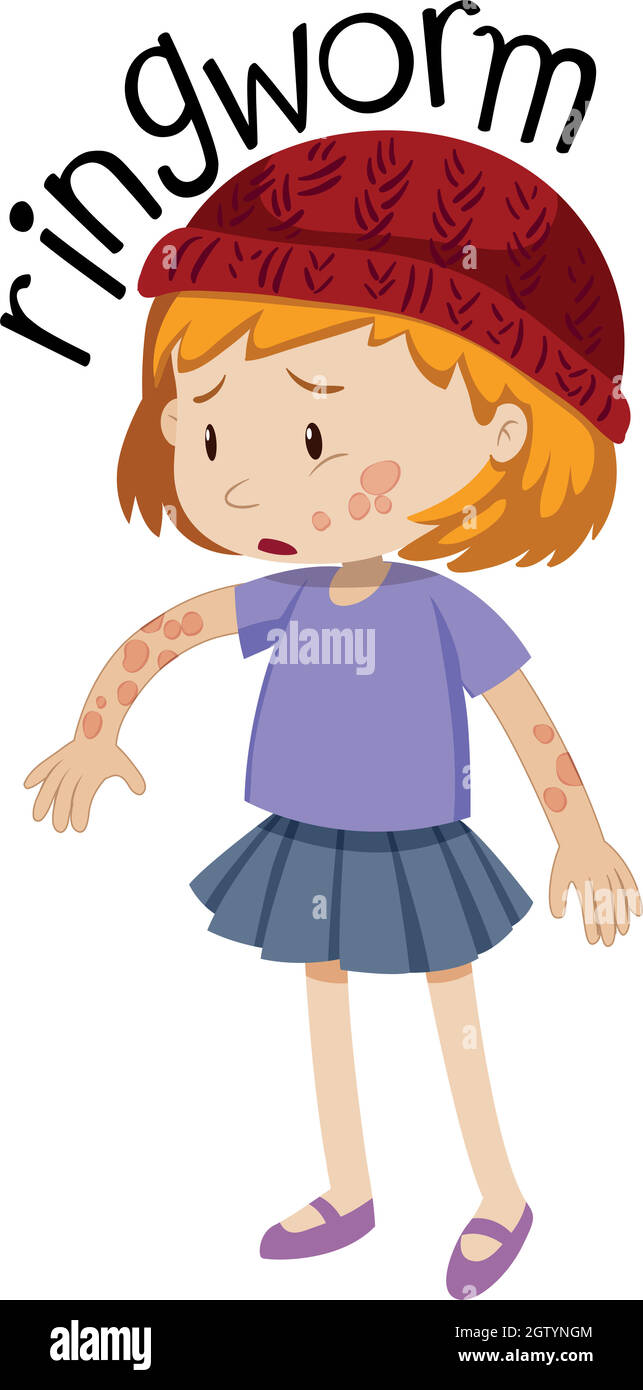 Ringworm hi-res stock photography and images - Alamy