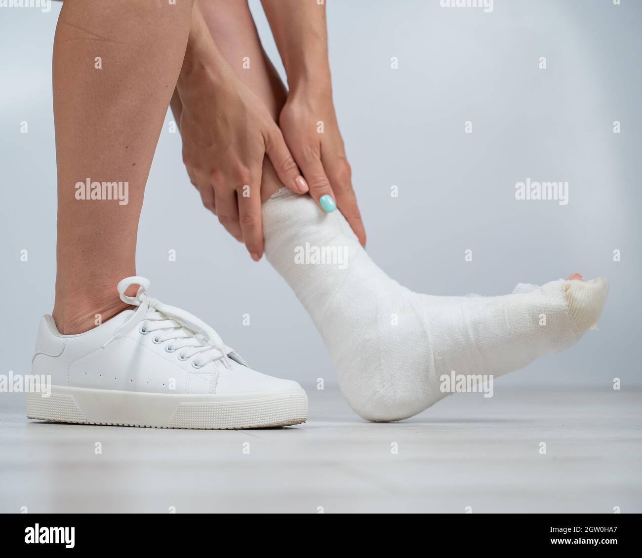 Close-up of female legs with plaster cast. A woman with a broken leg ...