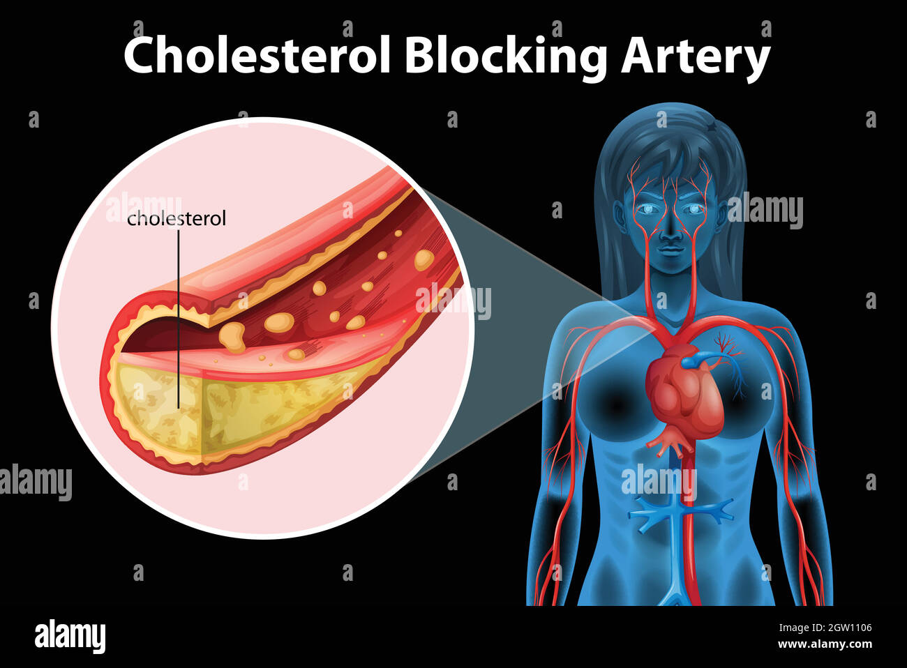 Deadly plaque Stock Vector Images - Alamy