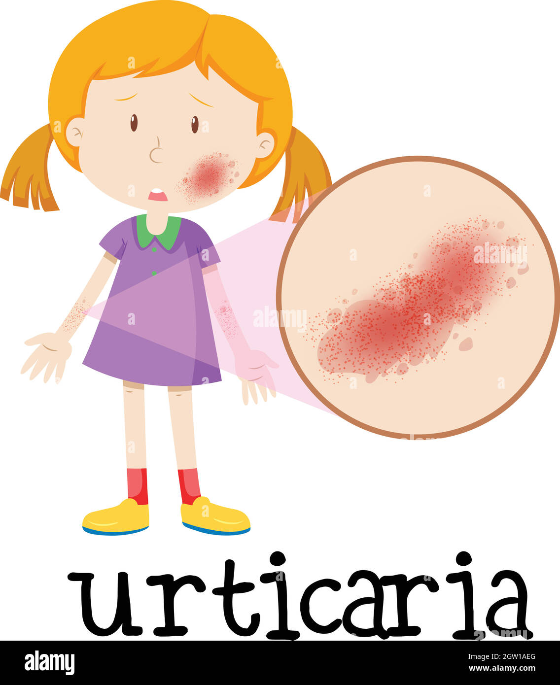 Skin rash urticaria allergic skin hi-res stock photography and images ...