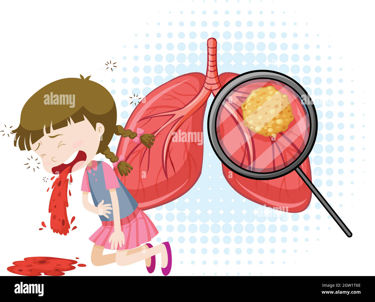 Tuberculosis drawing hi-res stock photography and images - Alamy