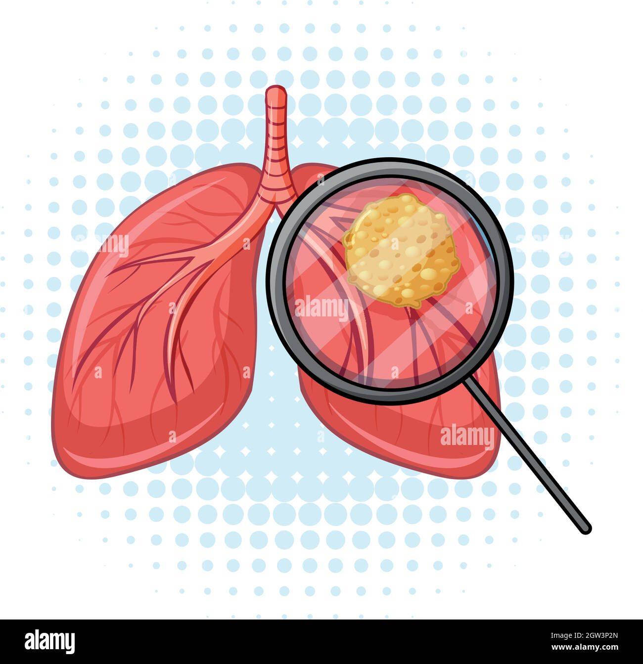 Cancer in human lungs Stock Vector Image & Art - Alamy