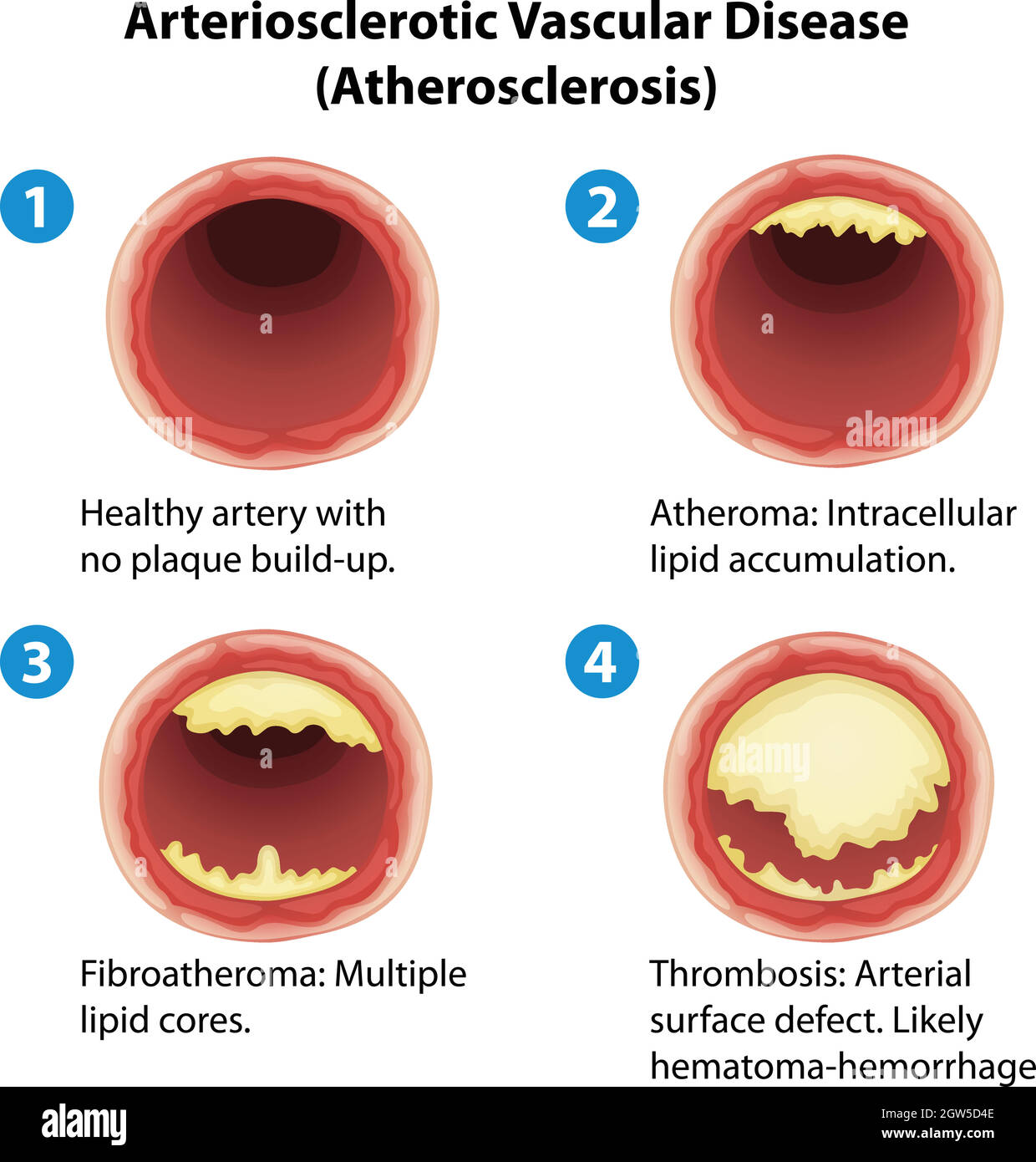 Deadly plaque hi-res stock photography and images - Alamy