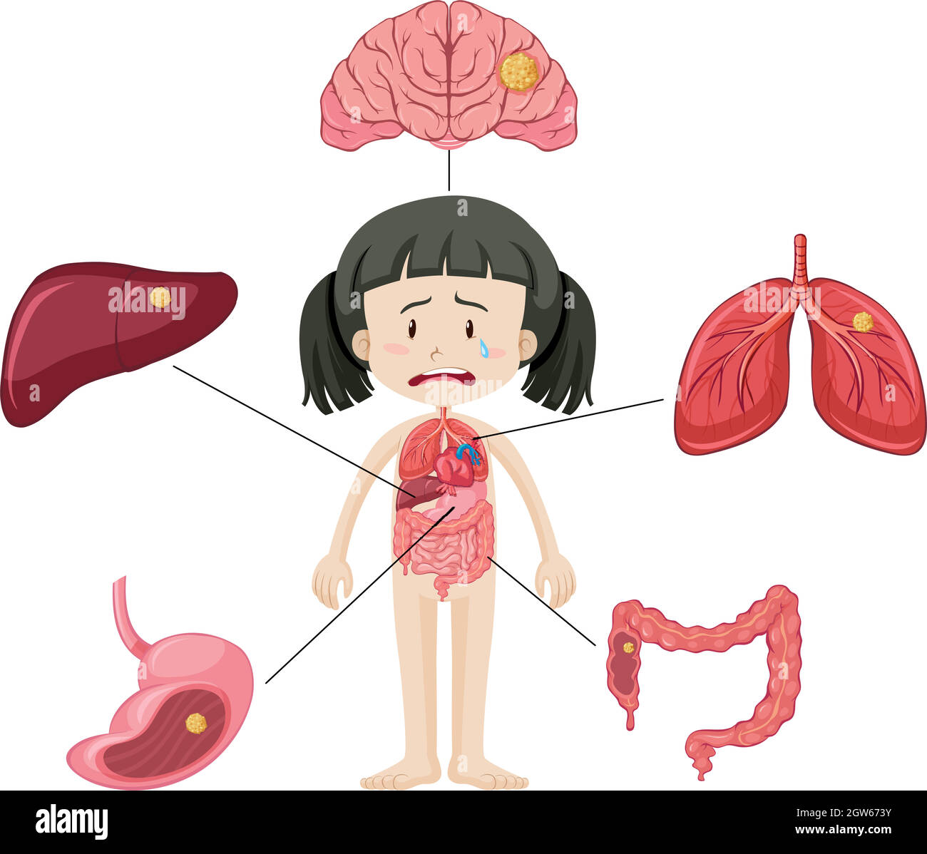 Sad girl and unhealthy boy diagram Stock Vector Image & Art - Alamy