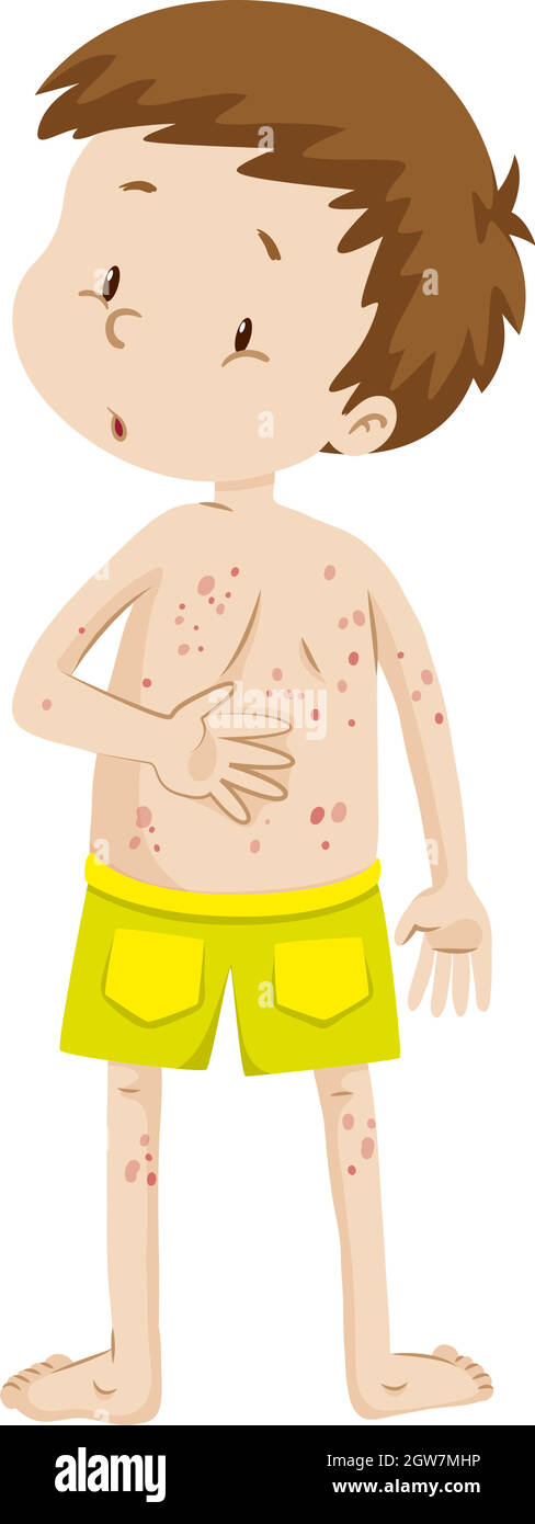 Little boy with rashes in his back Stock Vector Image & Art - Alamy