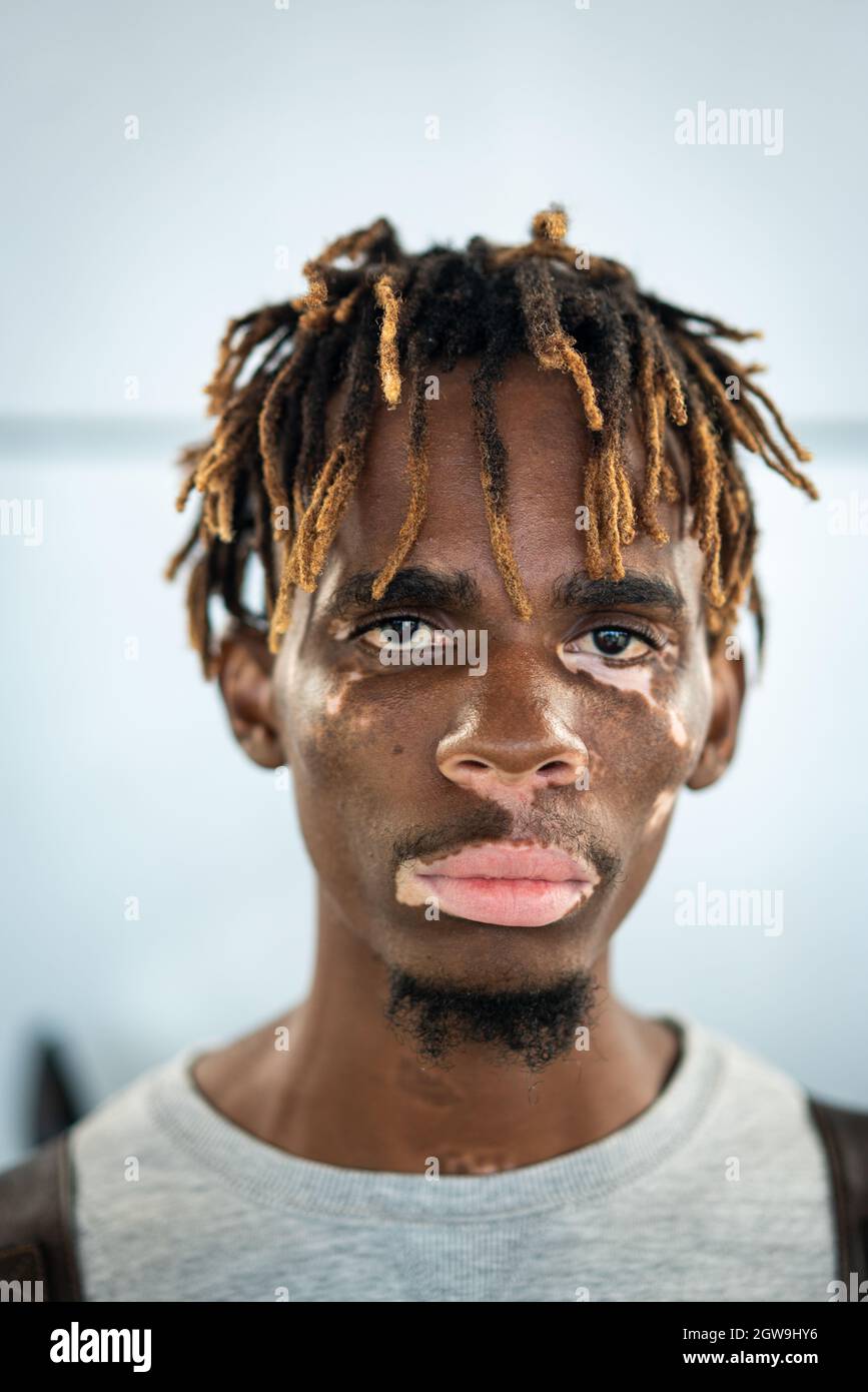 African vitiligo face hi-res stock photography and images - Alamy