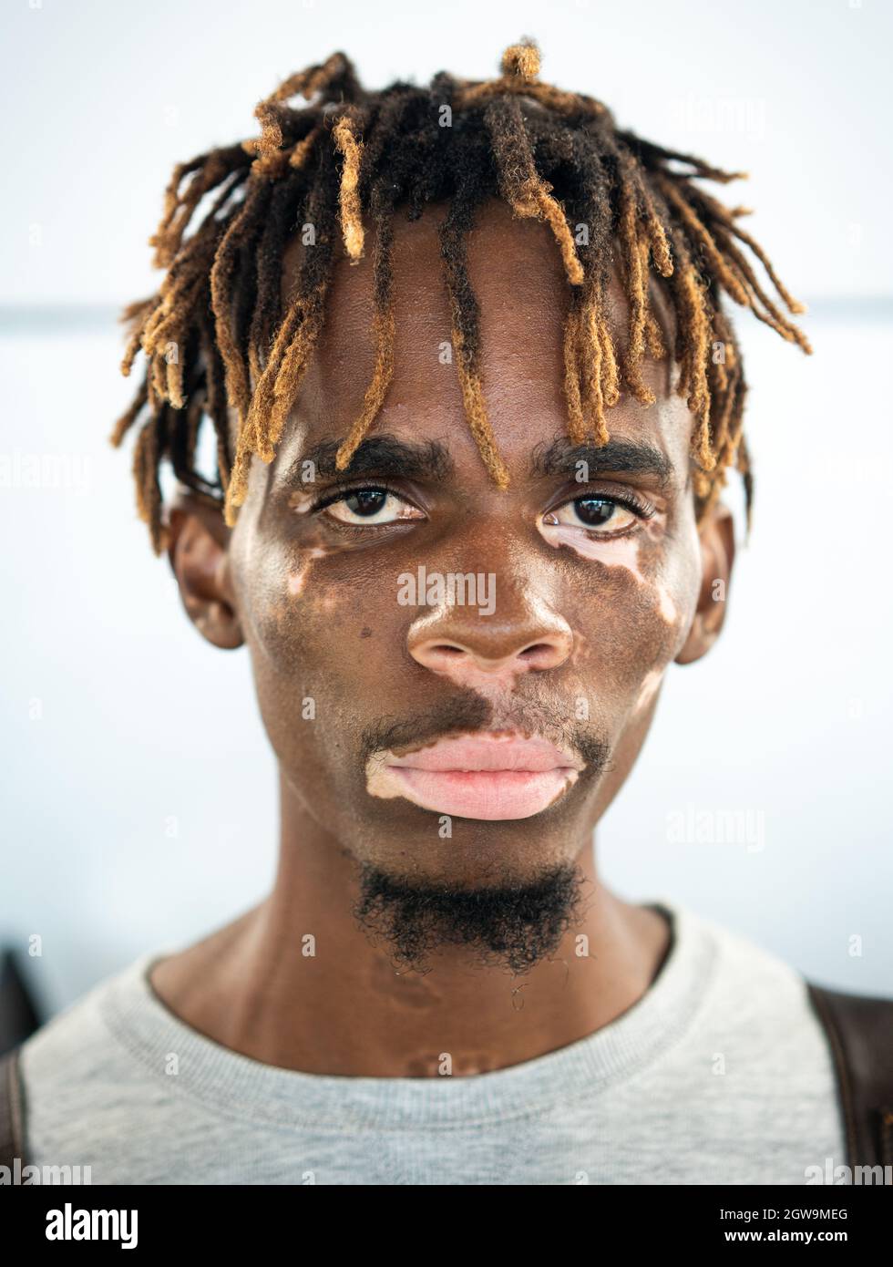 African American black young man with vitiligo skin Stock Photo - Alamy