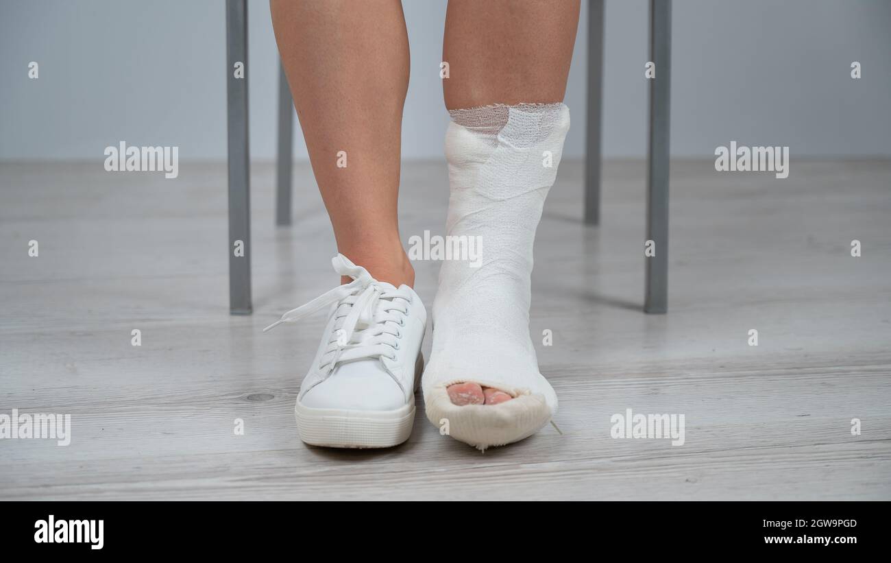 Close-up of female legs with plaster cast. A woman with a broken leg ...