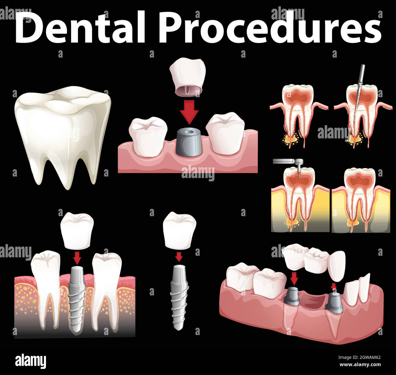 Tooth diagram clipart hi-res stock photography and images - Alamy