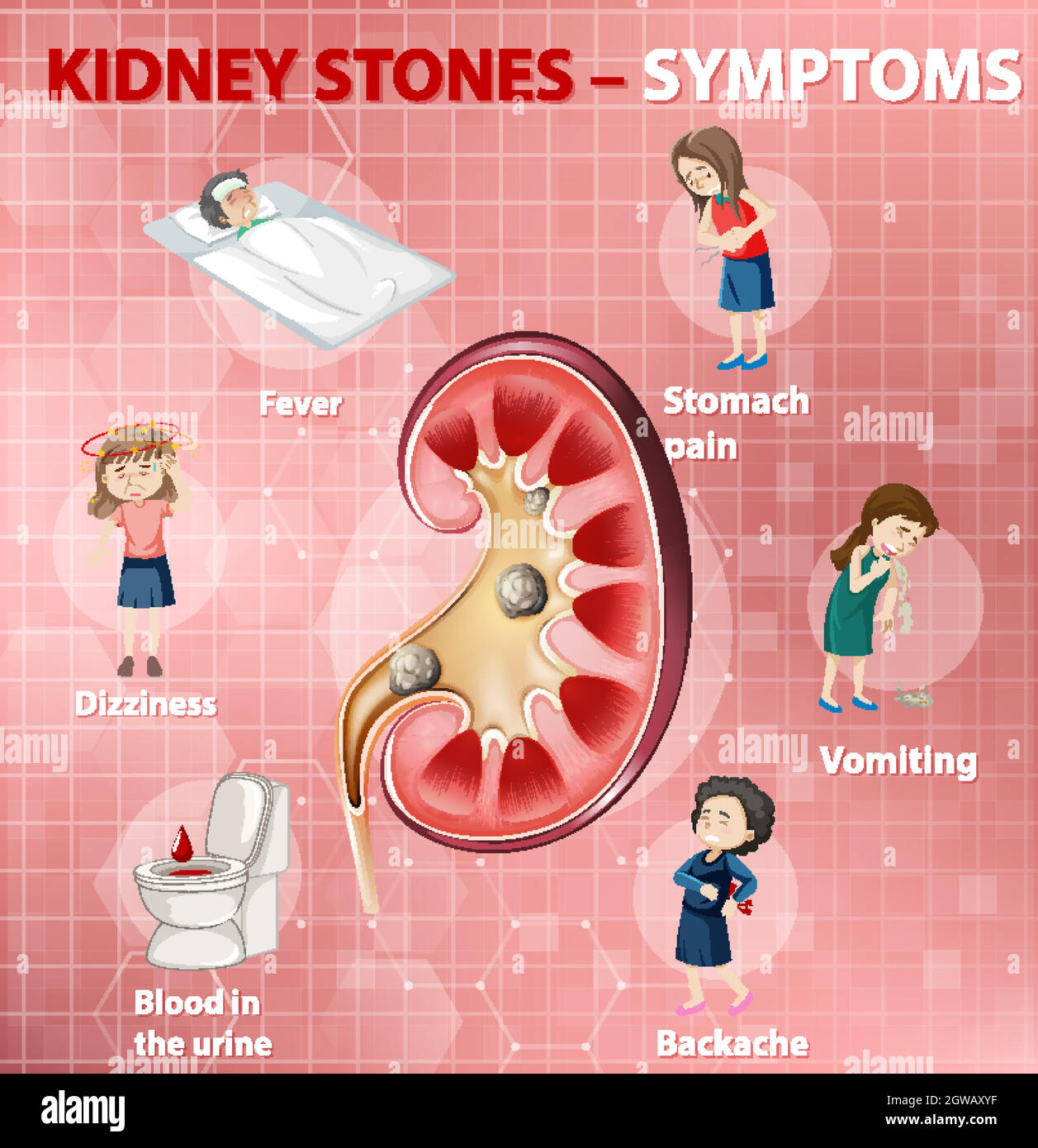 Kidney stones symptoms cartoon style infographic Stock Vector Image ...