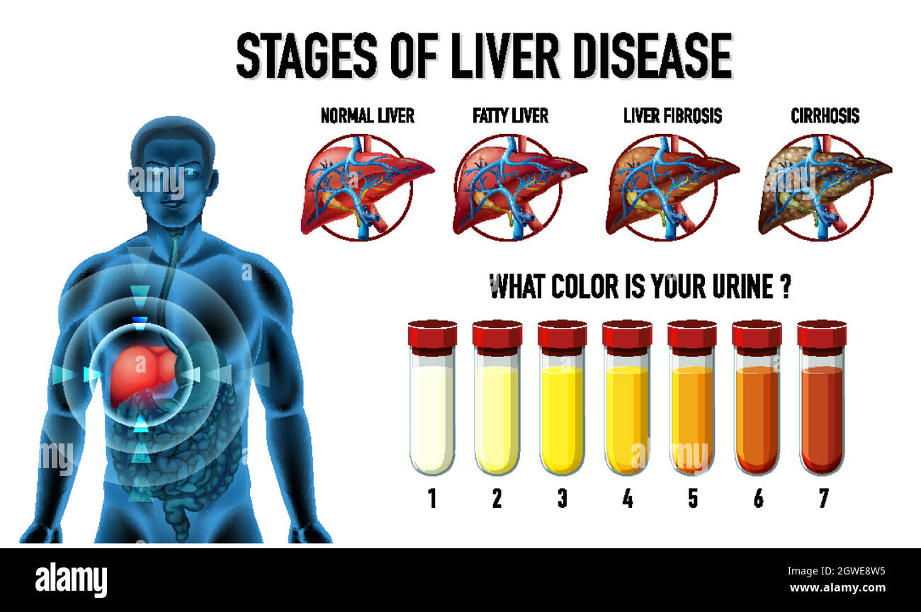 Stages of liver disease Stock Vector Image & Art - Alamy