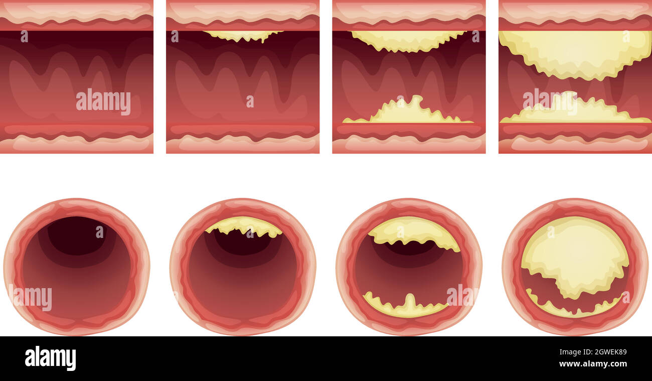 Deadly plaque hi-res stock photography and images - Alamy