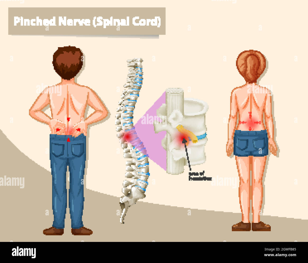 Diagram showing pinched nerve in human Stock Vector Image & Art - Alamy