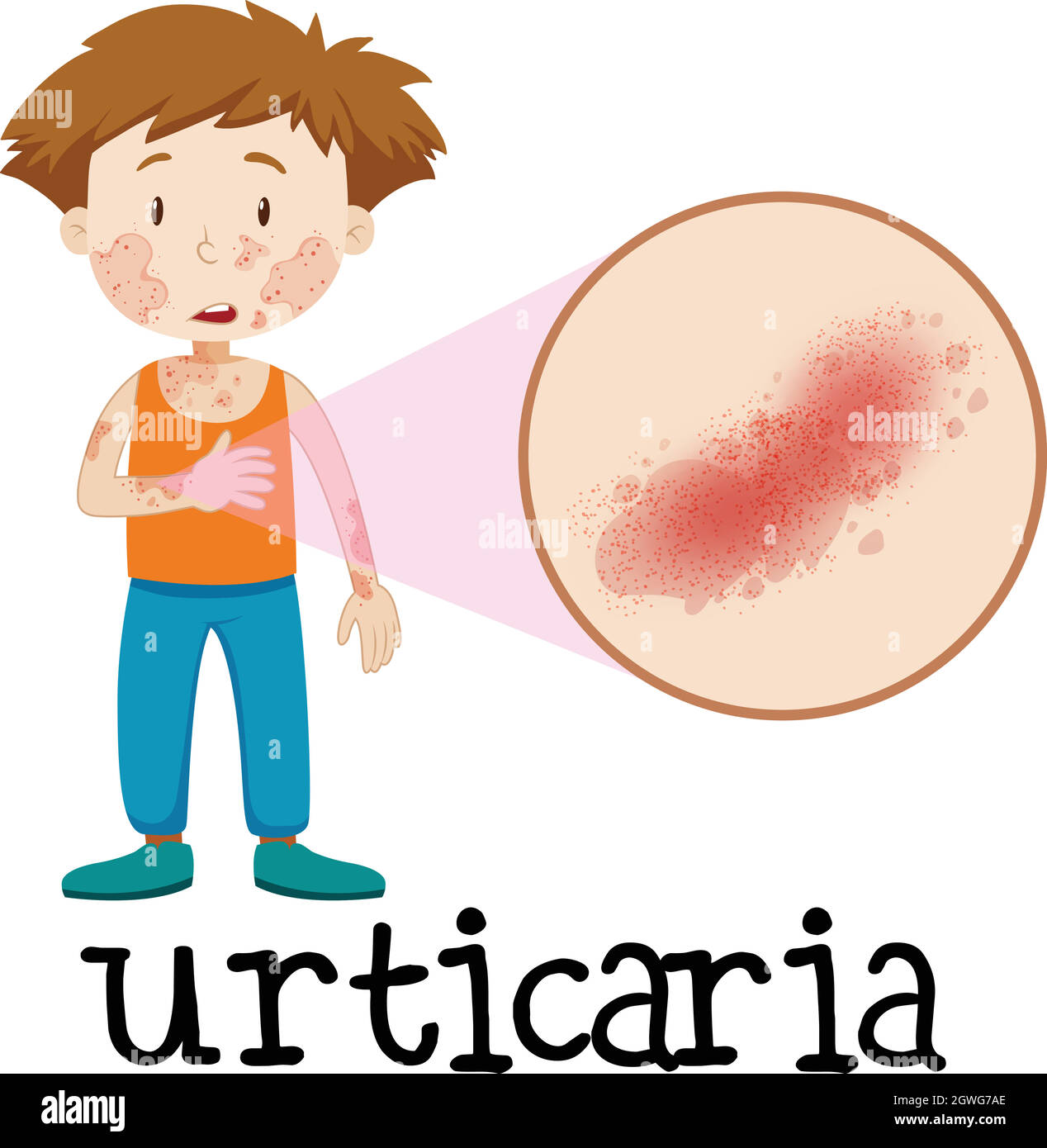 Allergic reaction skin Stock Vector Images - Alamy