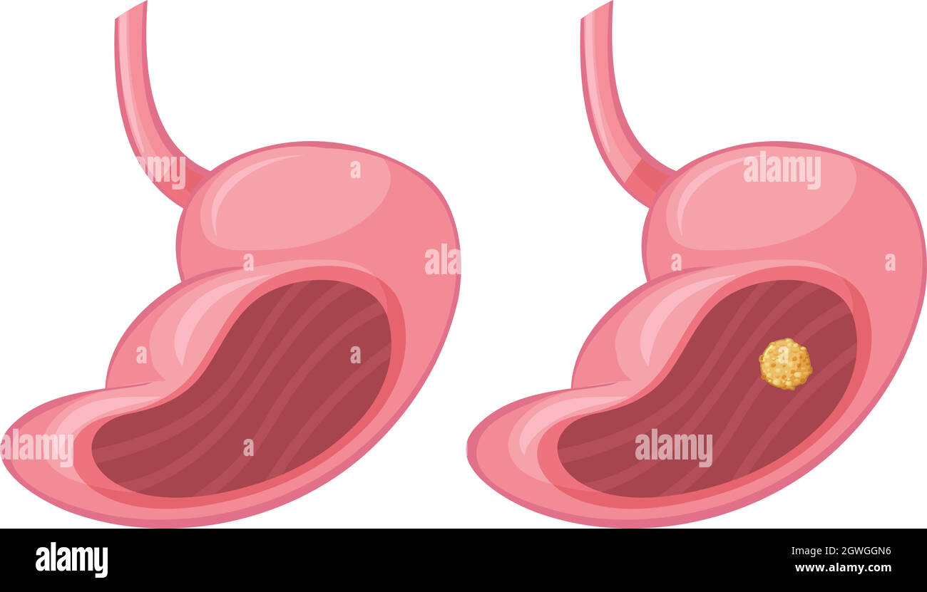 Human stomach and cancer Stock Vector Image & Art - Alamy