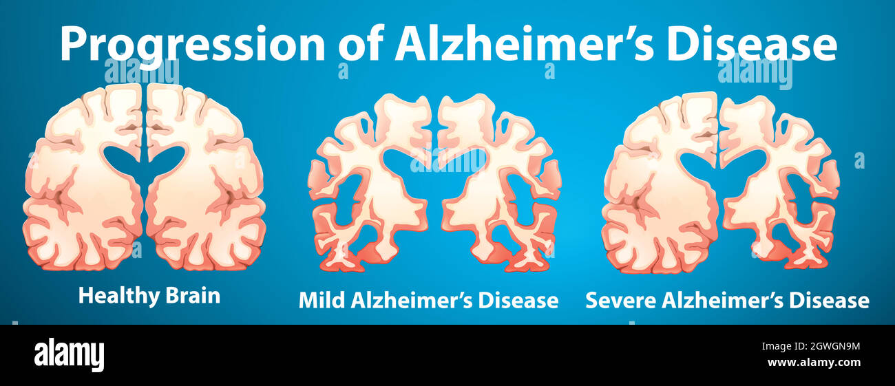 Alzheimers disease progression hi-res stock photography and images - Alamy