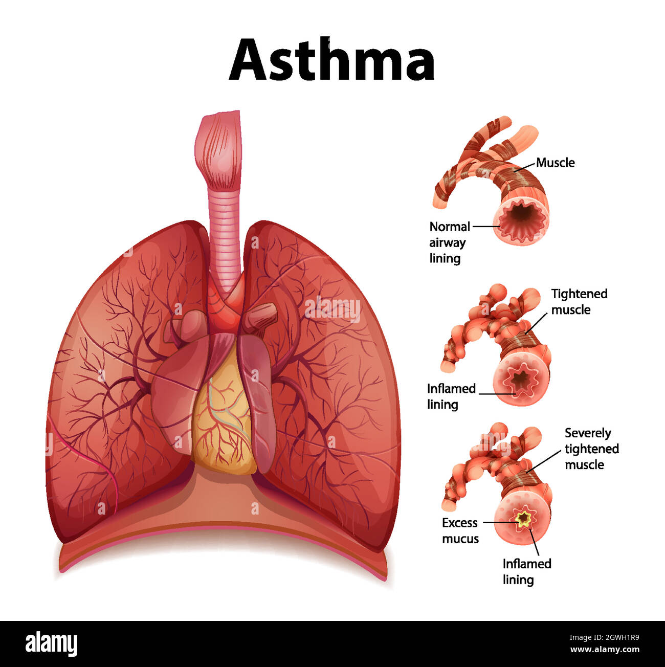 Comparison of healthy lung and Asthmatic lung Stock Vector Image & Art ...