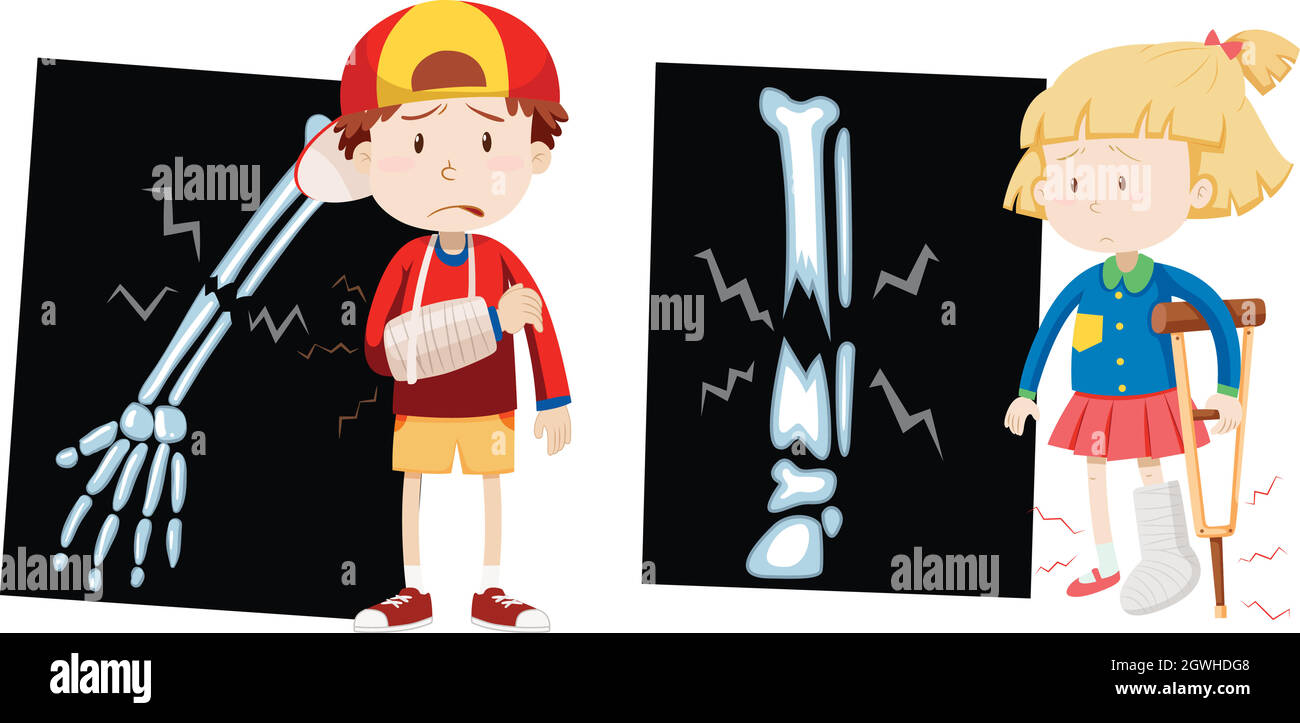 Broken leg boy hi-res stock photography and images - Alamy