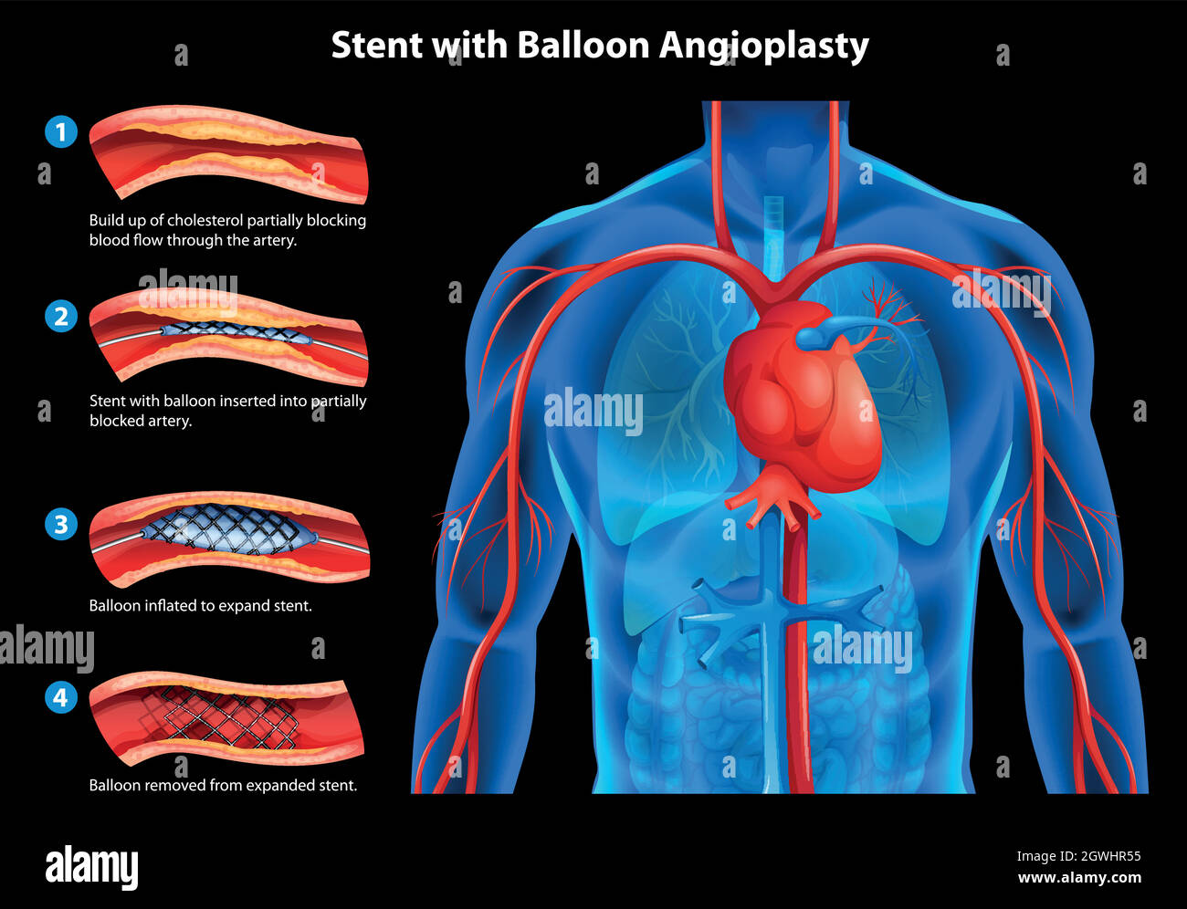 Is Balloon Angioplasty A Stent at Nate Hocking blog