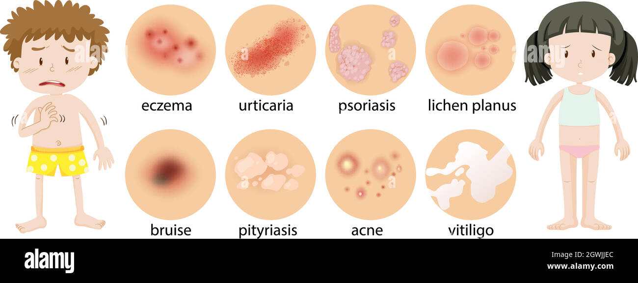 Young children with different skin conditions Stock Vector Image & Art ...