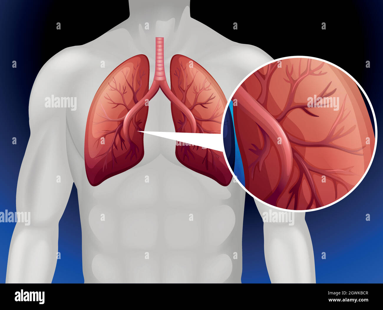 Lung cancer in human body Stock Vector Image & Art - Alamy