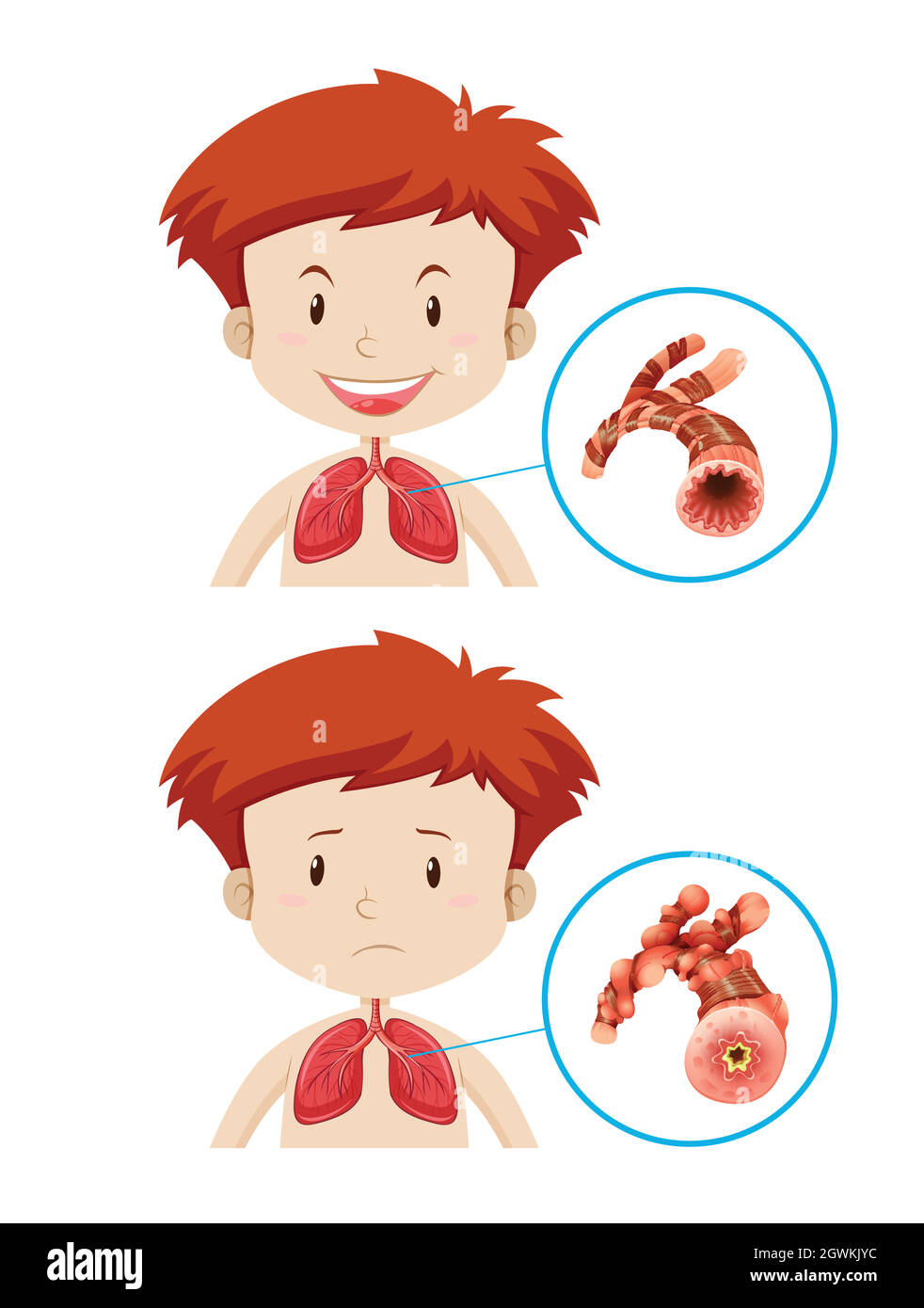 Healthy unhealthy kid Stock Vector Images - Alamy