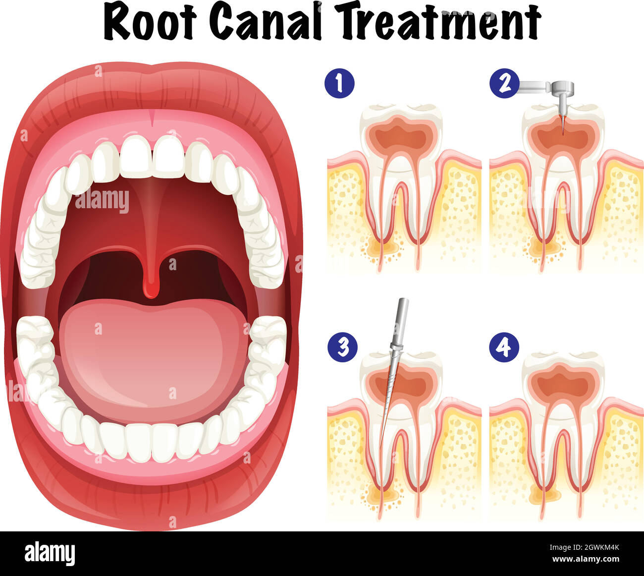 Endodontic Treatment Procedure